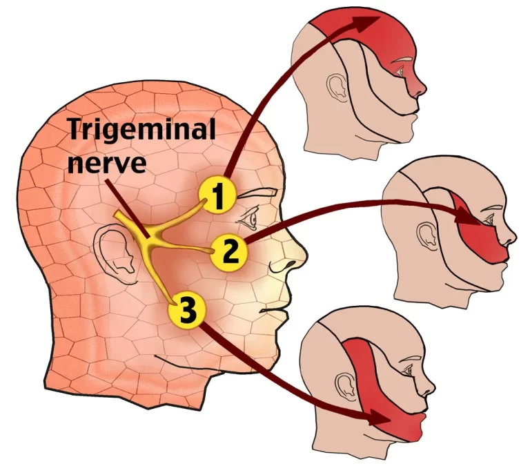 Trigeminal Neuralgia - Universal Hospital