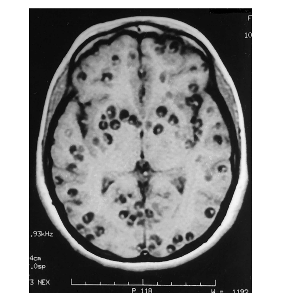 Neuro-Infectious Disease - Universal Hospital