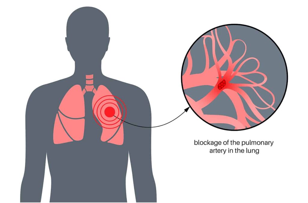 Pulmonary Embolism - Universal Hospital