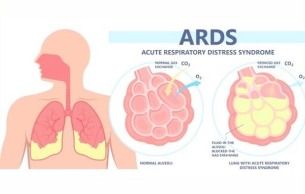 Acute Respiratory Distress Syndrome (ARDS) - Universal Hospital