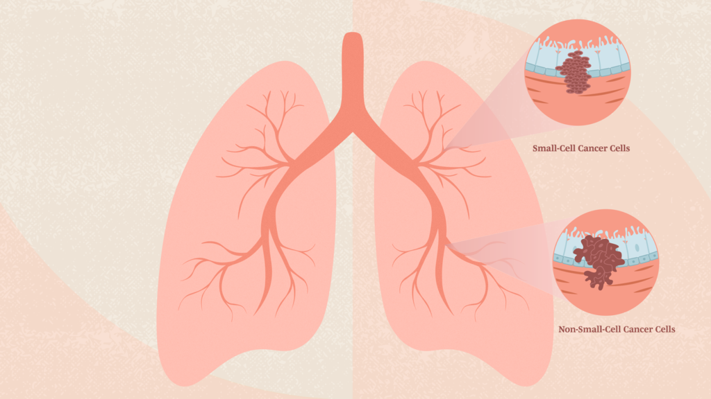 Lung Cancer - Universal Hospital