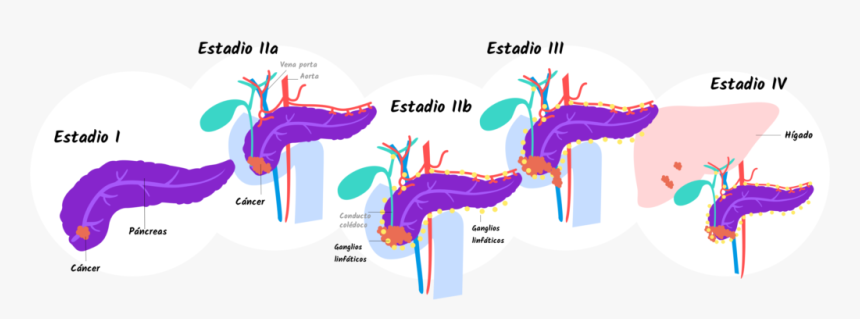 Pancreatic Cancer - Universal Hospital