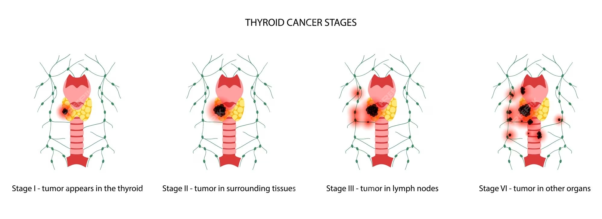Thyroid Cancer - Universal Hospital