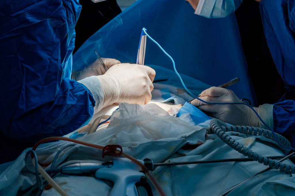 Electrosurgery - Universal Hospital